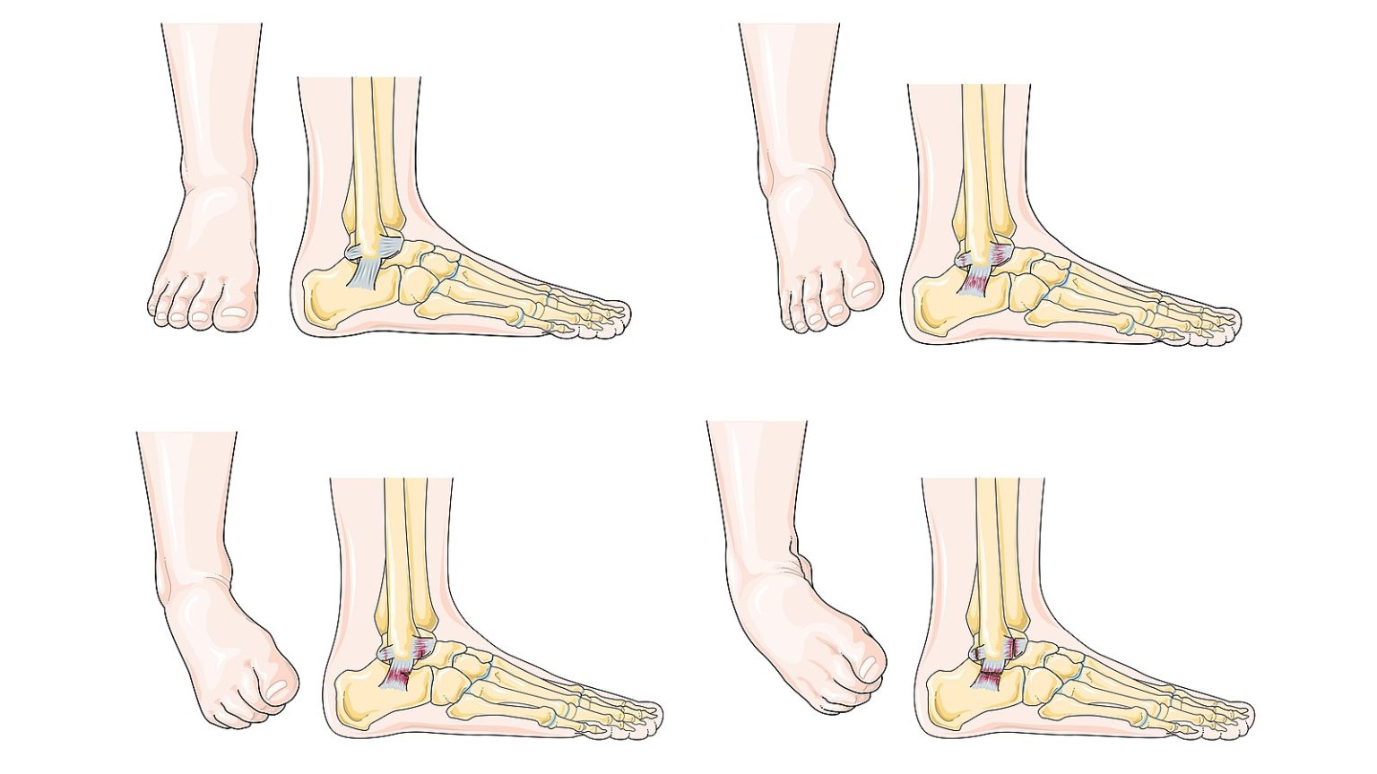 Chronic Ankle Instability - Healthy Feet Podiatry